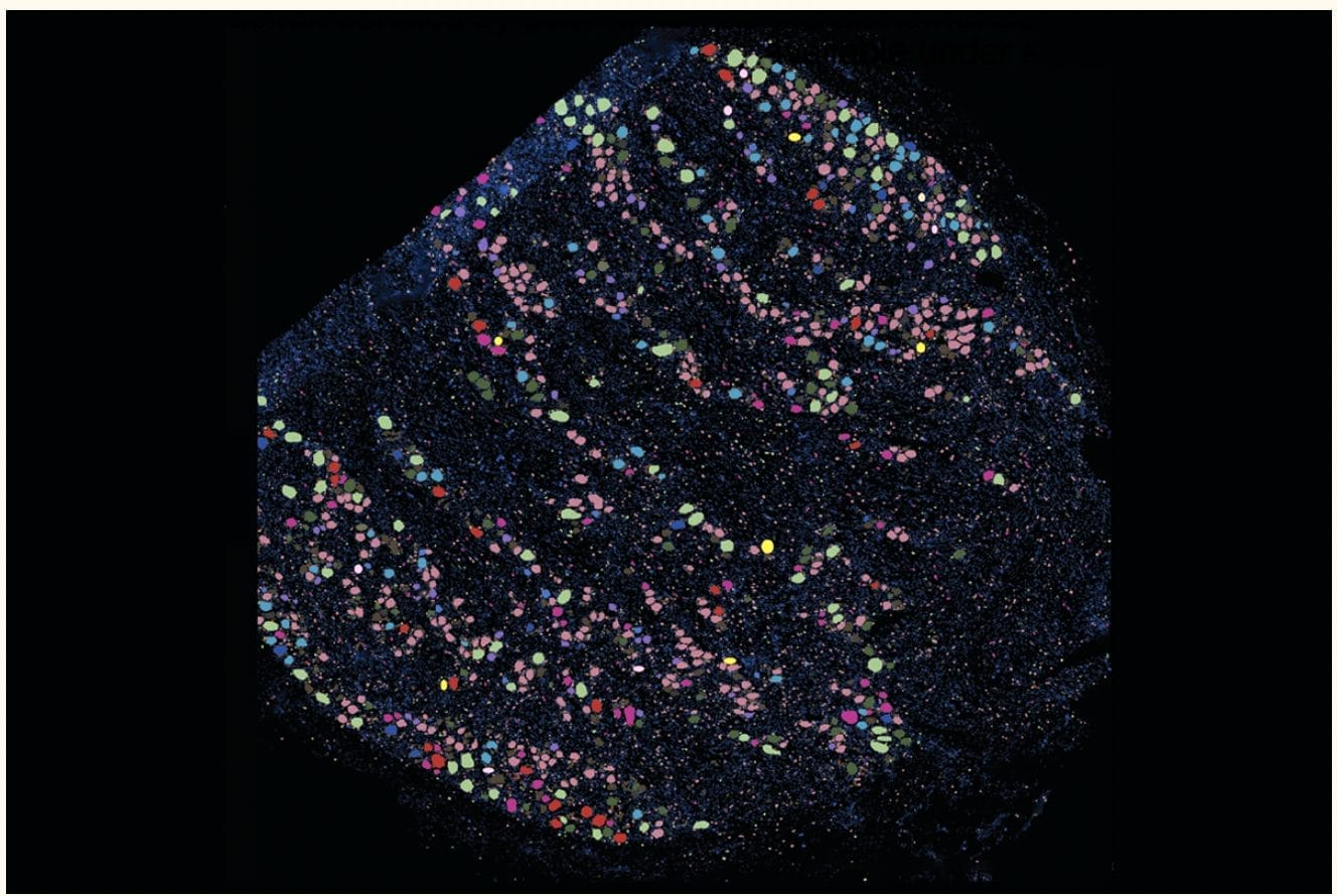 ‘Unprecedented’ dorsal root ganglion atlas captures 22 types of human ...